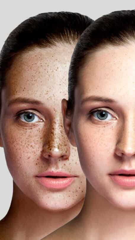 चेहरे की झाइयों को मिटा देंगे ये 4 पैक, Pigmentation की समस्या होगी दूर