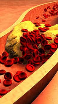 5 Specific Ways That May Reverse Clogged Arteries Naturally
